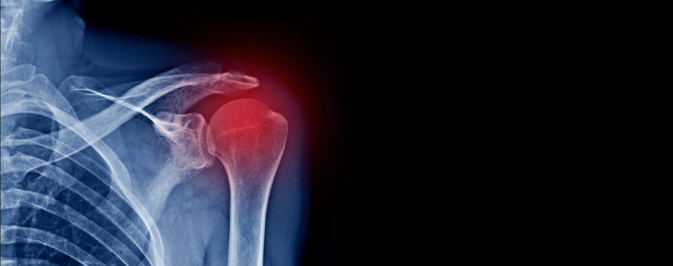 Bone Marrow Aspirate Concentrate Injection In Dallas, TX | Foundation ...